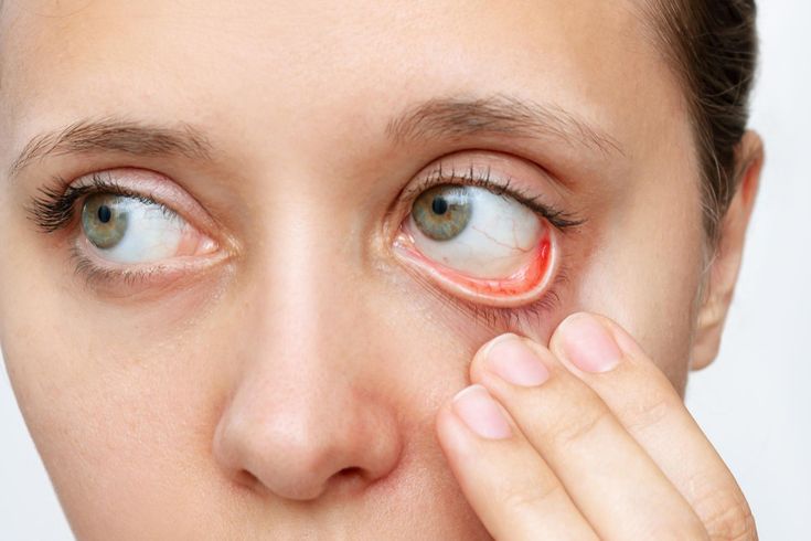 Uveitis: sintomas, tratamiento y como afecta a tu visión