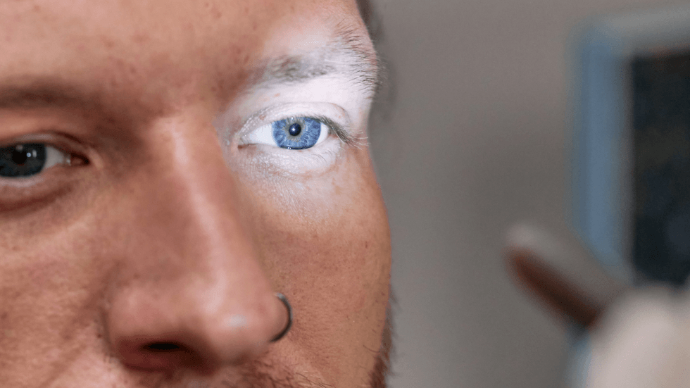 Halos de luz y glaucoma: qué es y cómo afecta a tus ojos