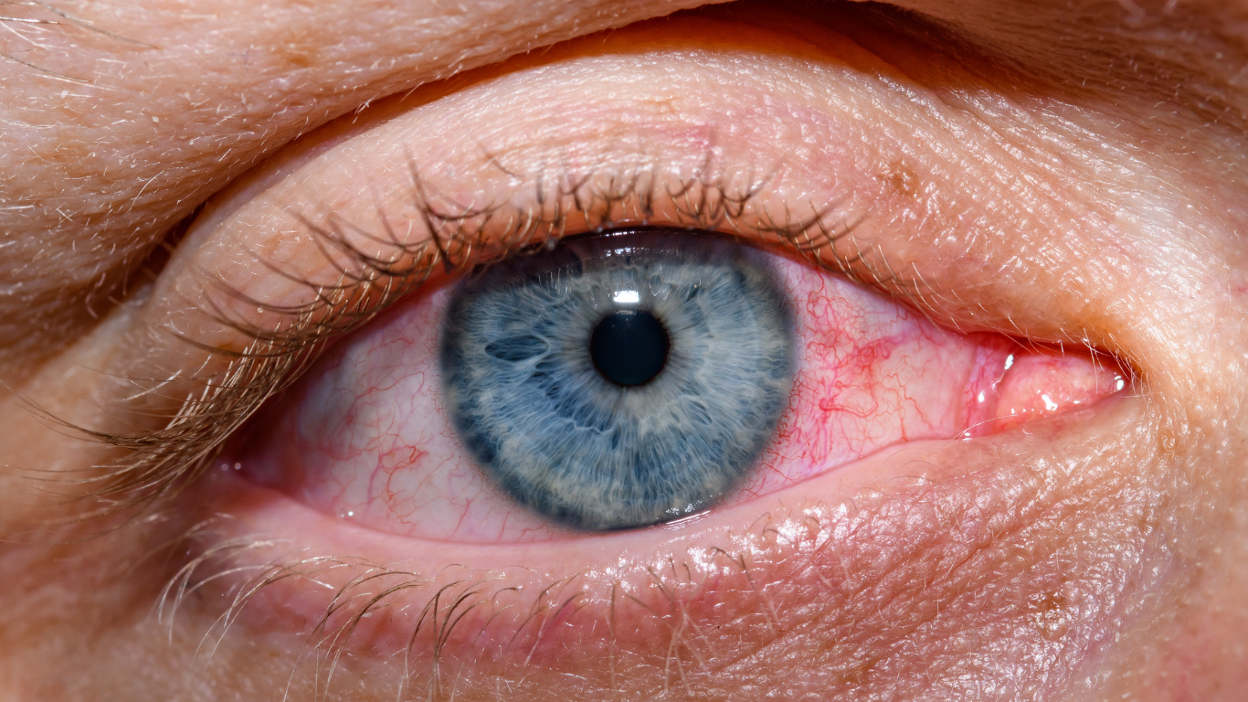 Neovascularización corneal: causas, síntomas y tratamientos