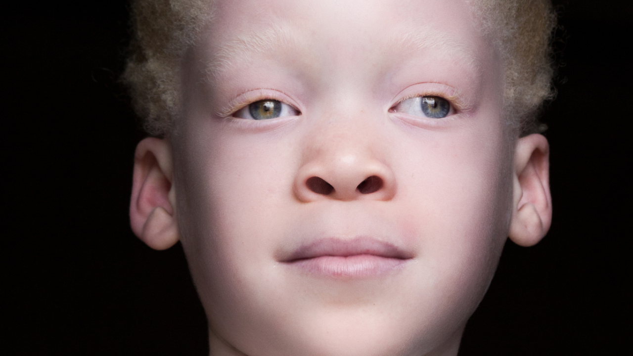 Albinismo Ocular: síntomas, causas y tratamientos efectivos