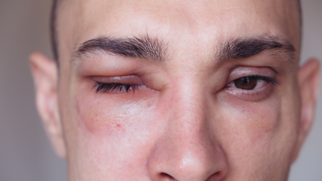 Celulitis orbitaria: causas, síntomas y tratamientos claves